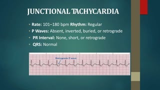 Junctional Tachycardia