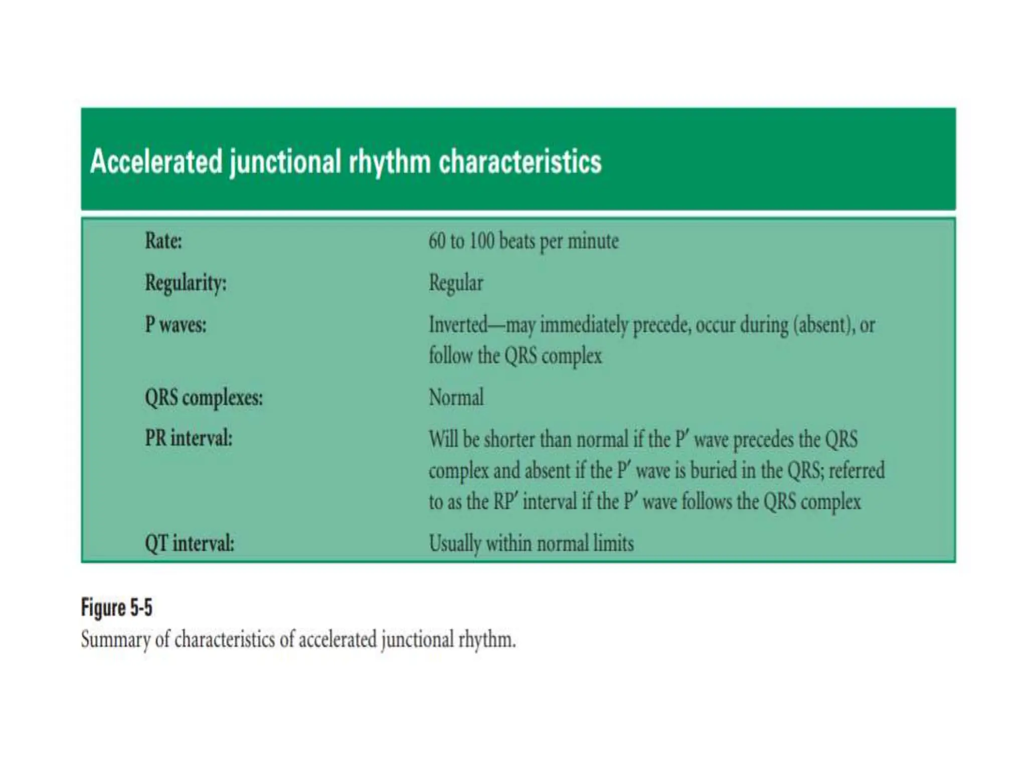 JUNCTIONAL DYSRHYTHMIAS AND HOW TO INTERPRET IN ECG? | PPTX