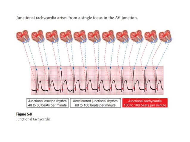 JUNCTIONAL DYSRHYTHMIAS AND HOW TO INTERPRET IN ECG? | PPT
