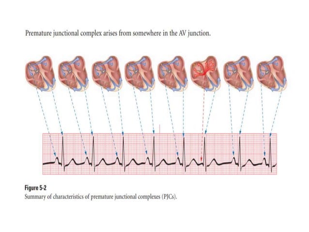 JUNCTIONAL DYSRHYTHMIAS AND HOW TO INTERPRET IN ECG? | PPTX