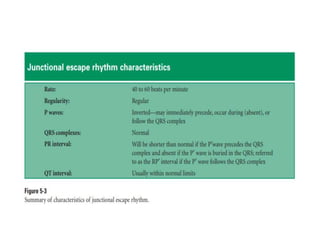 JUNCTIONAL DYSRHYTHMIAS AND HOW TO INTERPRET IN ECG? | PPTX