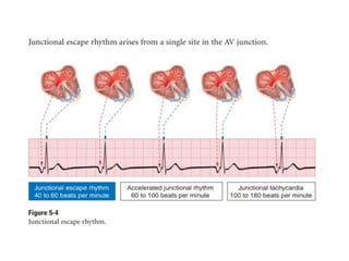 JUNCTIONAL DYSRHYTHMIAS AND HOW TO INTERPRET IN ECG? | PPTX