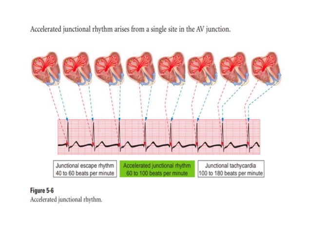 JUNCTIONAL DYSRHYTHMIAS AND HOW TO INTERPRET IN ECG? | PPTX