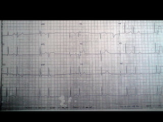 ECG: Junctional Escape Rhythm | PPT