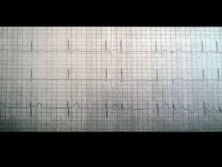 ECG: Junctional Escape Rhythm | PPT