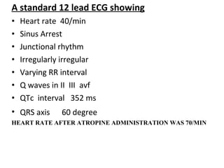 ECG: Junctional Escape Rhythm | PPT