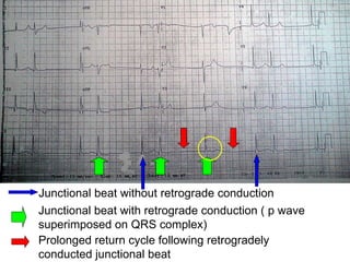 ECG: Junctional Escape Rhythm | PPT