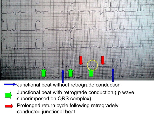 ECG: Junctional Escape Rhythm | PPT
