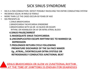ECG: Junctional Escape Rhythm | PPT