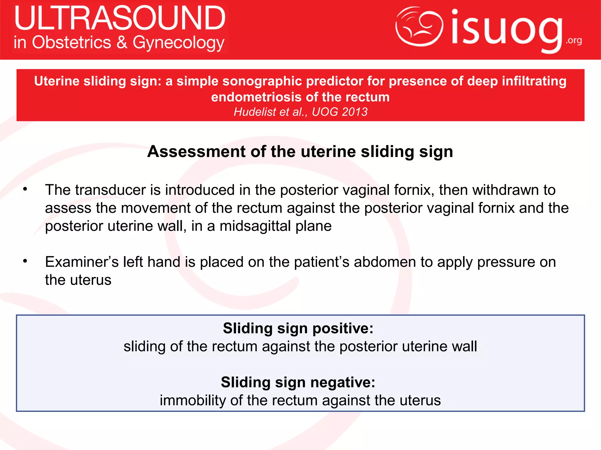 UOG Journal Club: Uterine sliding sign in DIE | PPT