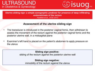 UOG Journal Club: Uterine sliding sign in DIE | PPT