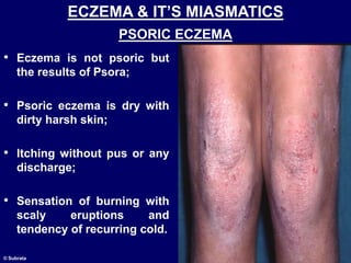 JUNE 2015-ECZEMA JUNE 2015-ECZEMA JUNE 2015-ECZEMA.ppt