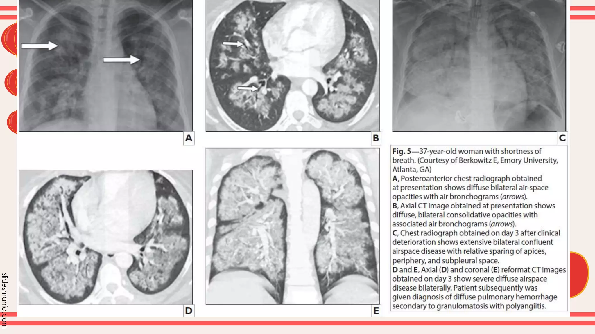 Jurding Diffuse Pulmonary Hemorrhage.pptx