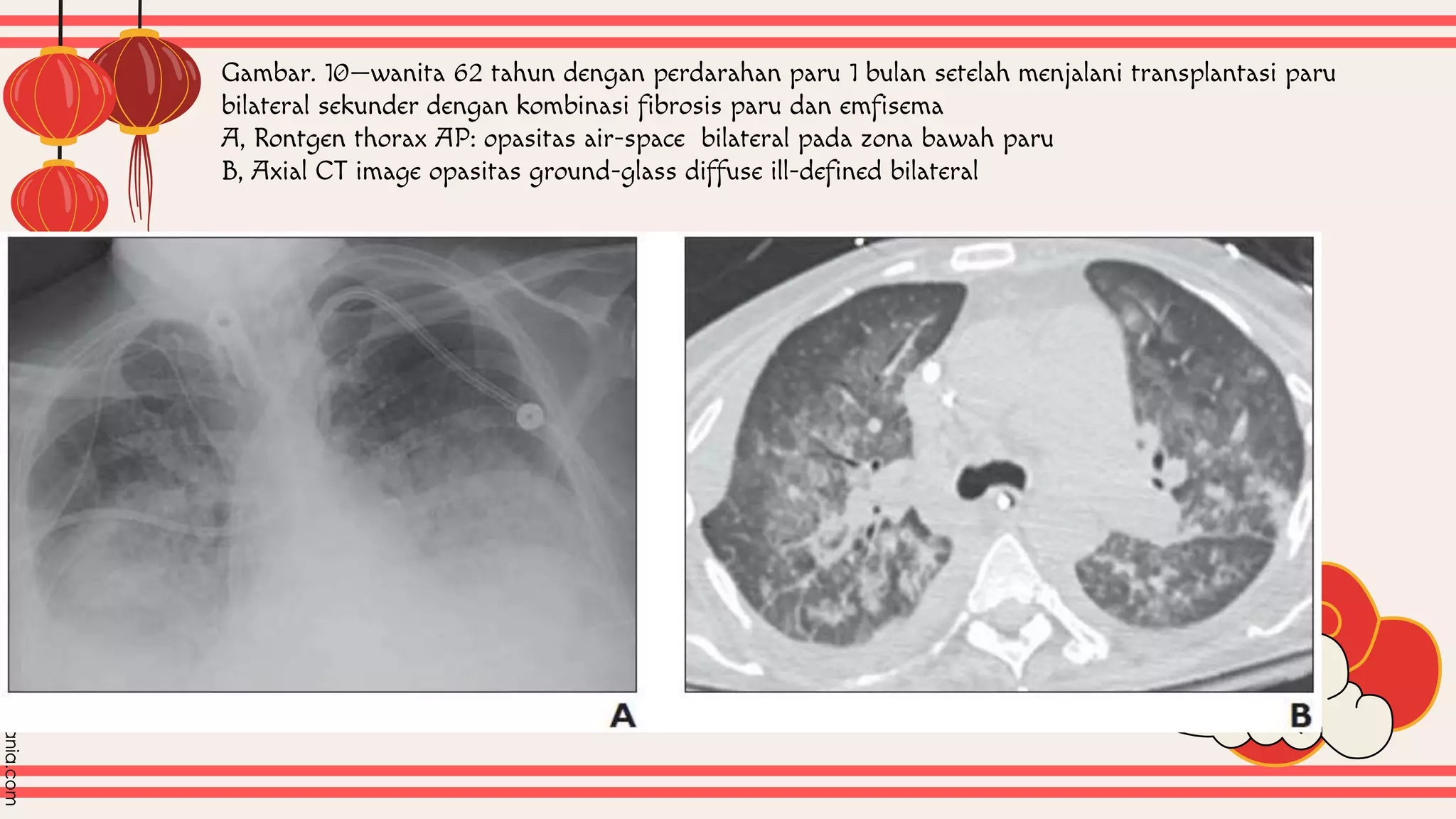 Jurding Diffuse Pulmonary Hemorrhage.pptx