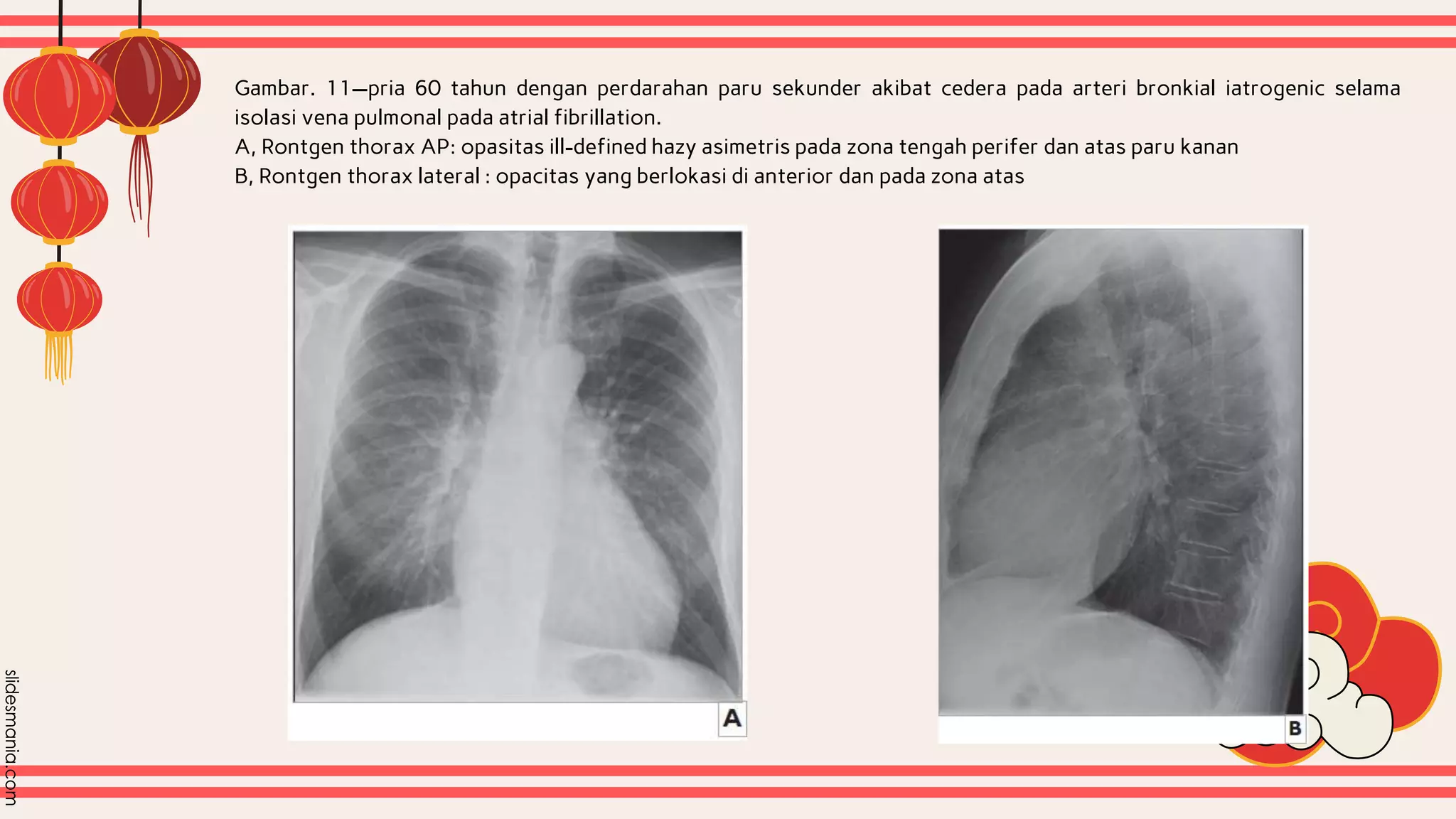 Jurding Diffuse Pulmonary Hemorrhage.pptx