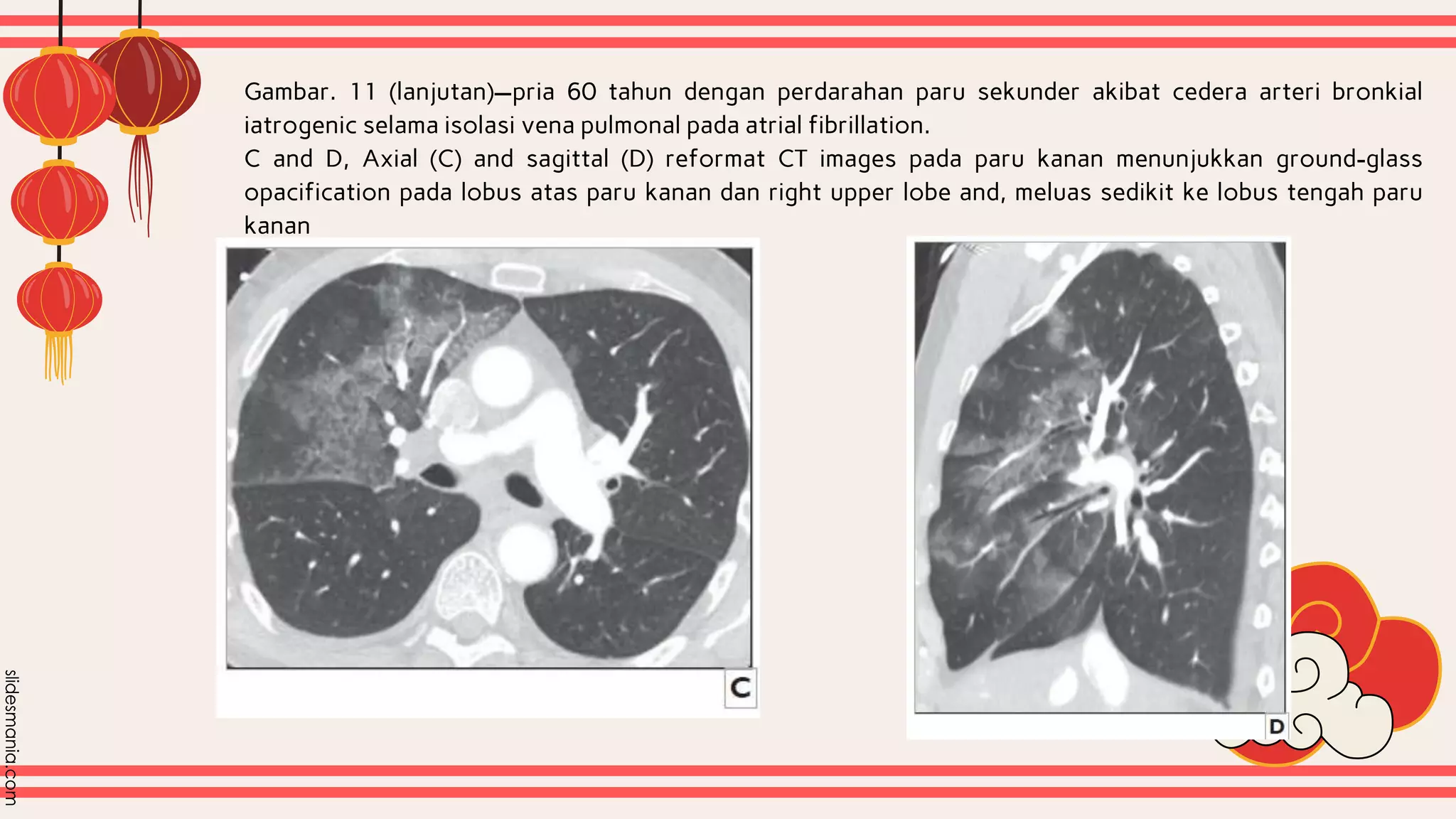 Jurding Diffuse Pulmonary Hemorrhage.pptx