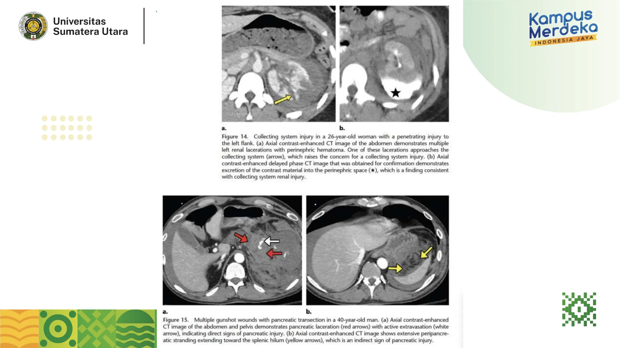 CT scan of penetrating abdominopelvic trauma | PPT