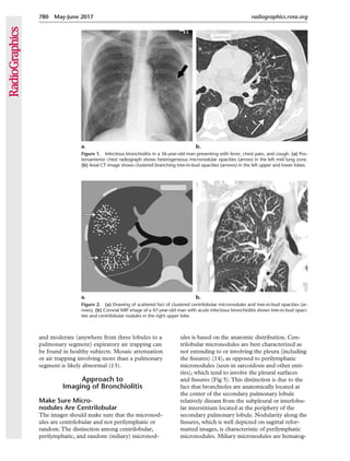 Bronchiolitis : a practice for general radiologists | PDF