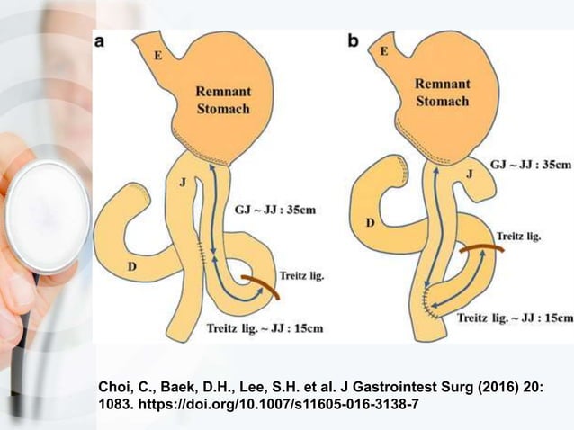 Journal reading Billroth 2 vs Roux-en-Y in Distal Gastrectomy | PPT