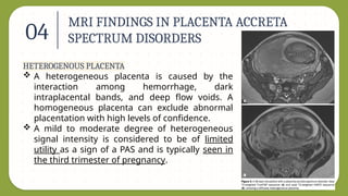 Placenta Accreta Spectrum imaging MRI.pptx