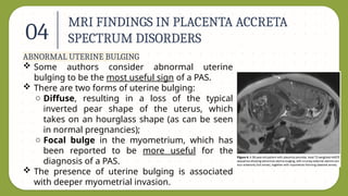 Placenta Accreta Spectrum imaging MRI.pptx