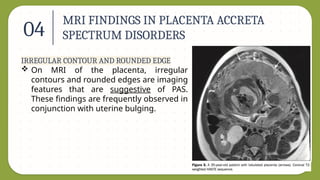 Placenta Accreta Spectrum imaging MRI.pptx