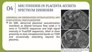 Placenta Accreta Spectrum imaging MRI.pptx