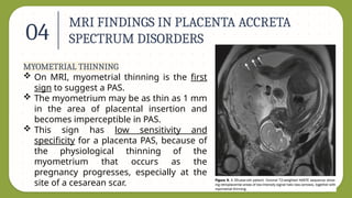 Placenta Accreta Spectrum imaging MRI.pptx