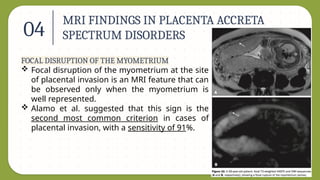 Placenta Accreta Spectrum imaging MRI.pptx