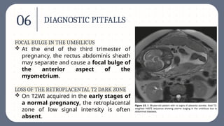 Placenta Accreta Spectrum imaging MRI.pptx
