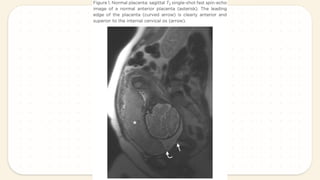 Placenta Accreta Spectrum imaging MRI.pptx