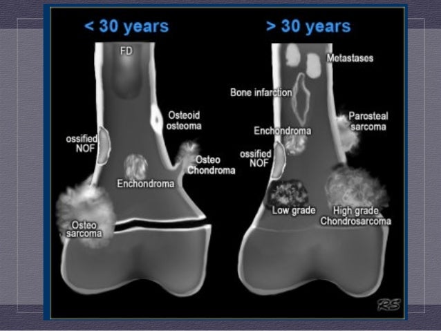 Enchondroma with Secondary Aneurysmal Bone Cyst