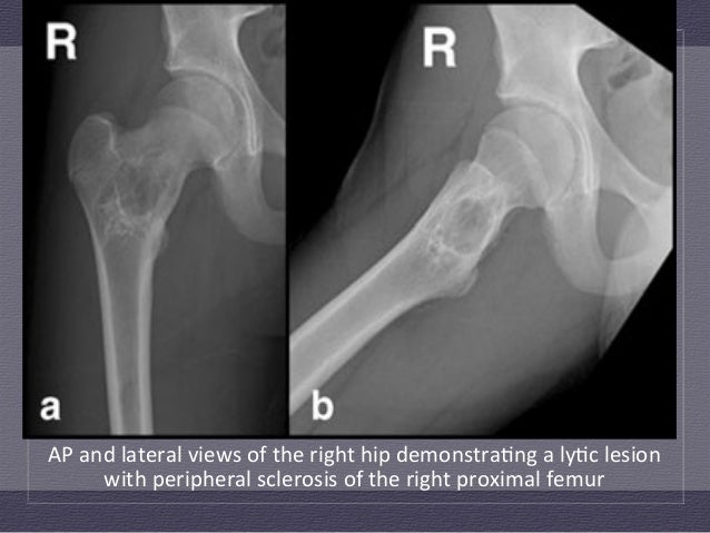 Enchondroma with Secondary Aneurysmal Bone Cyst