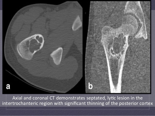 Enchondroma with Secondary Aneurysmal Bone Cyst