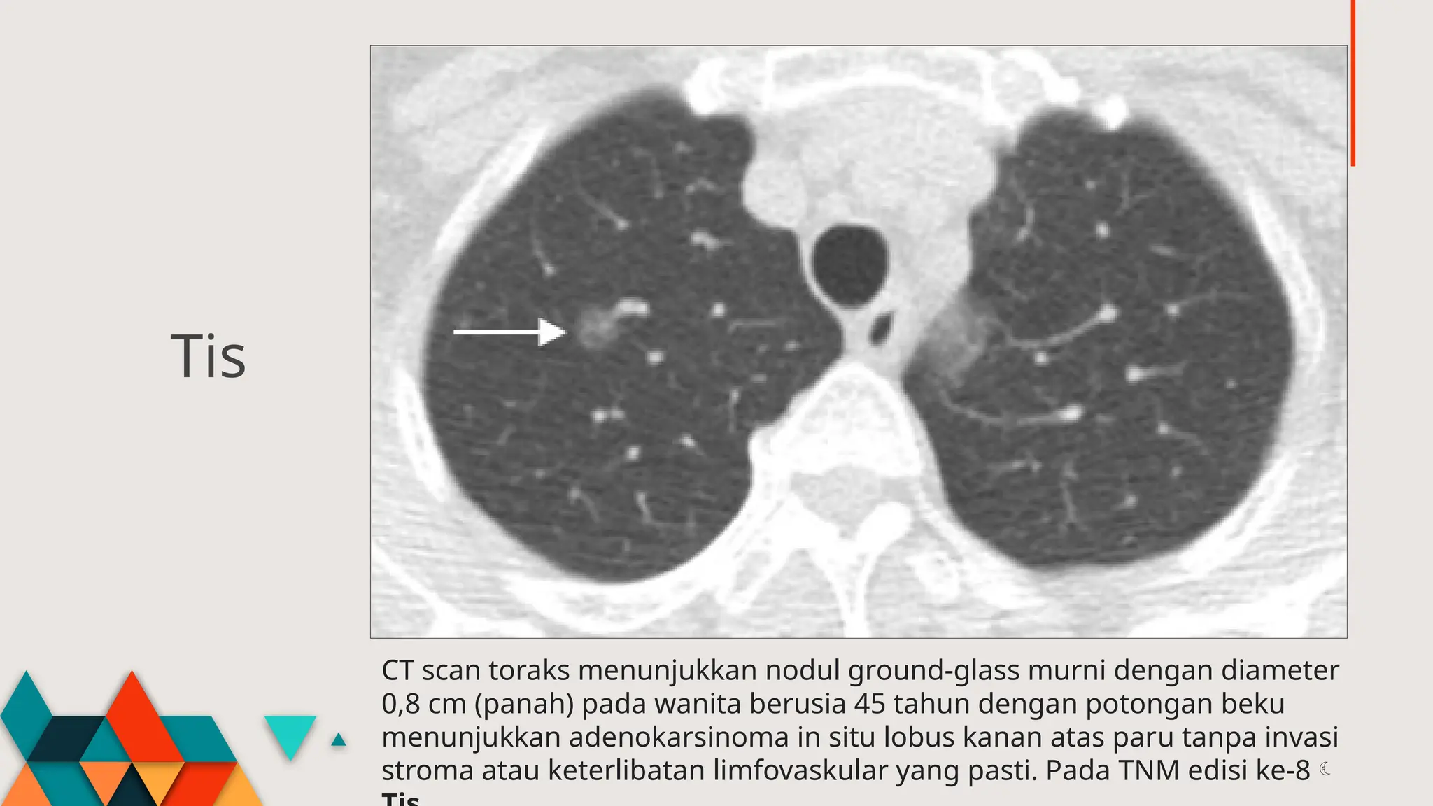 The new 8th TNM staging system of lung cancer | PPTX
