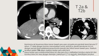The new 8th TNM staging system of lung cancer | PPTX