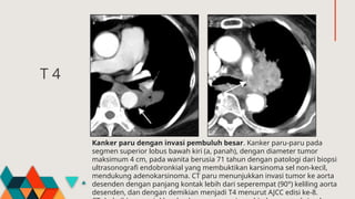 The new 8th TNM staging system of lung cancer | PPTX