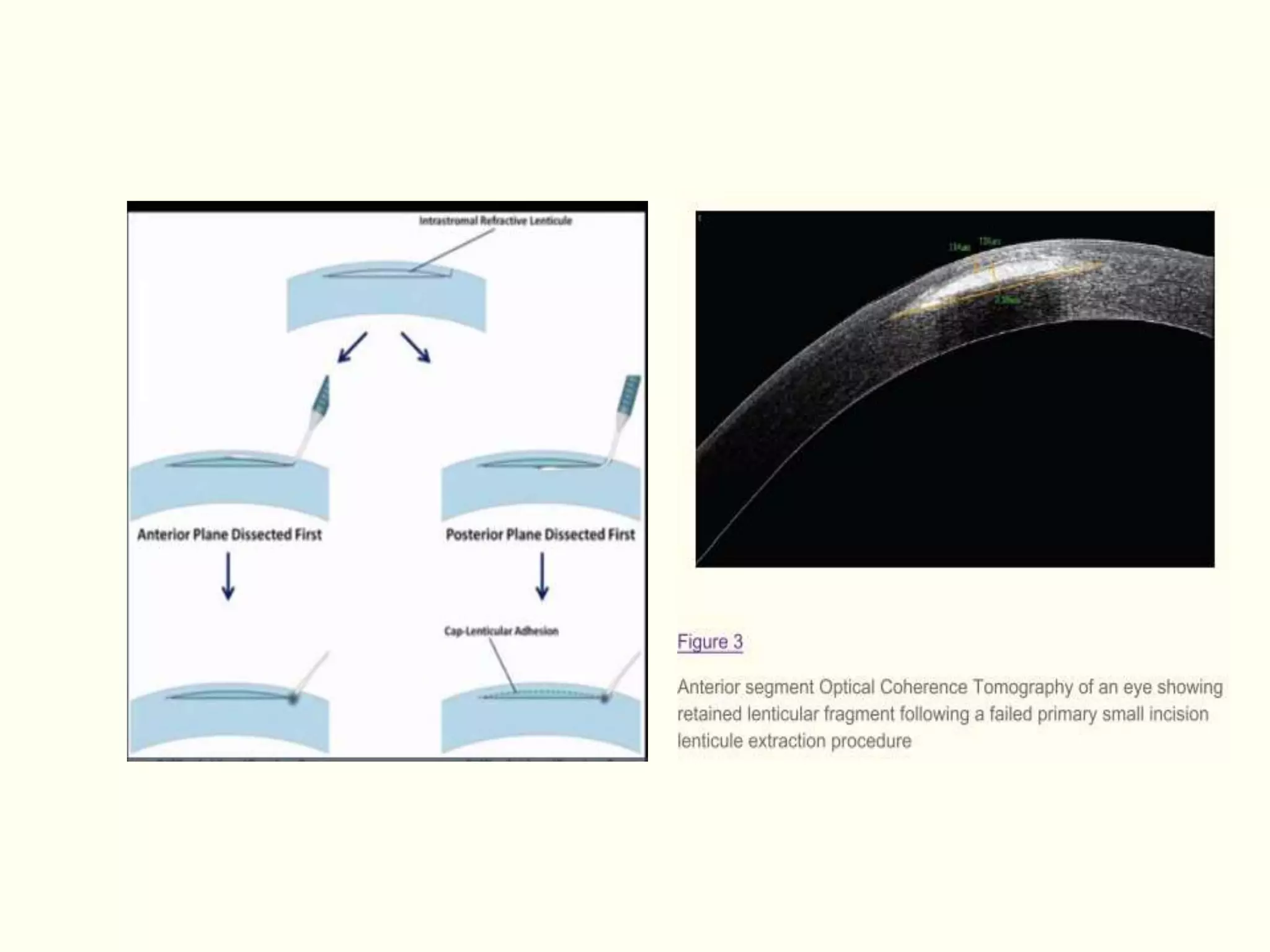 Just SMILE (small incision lenticule extraction ) | PPTX