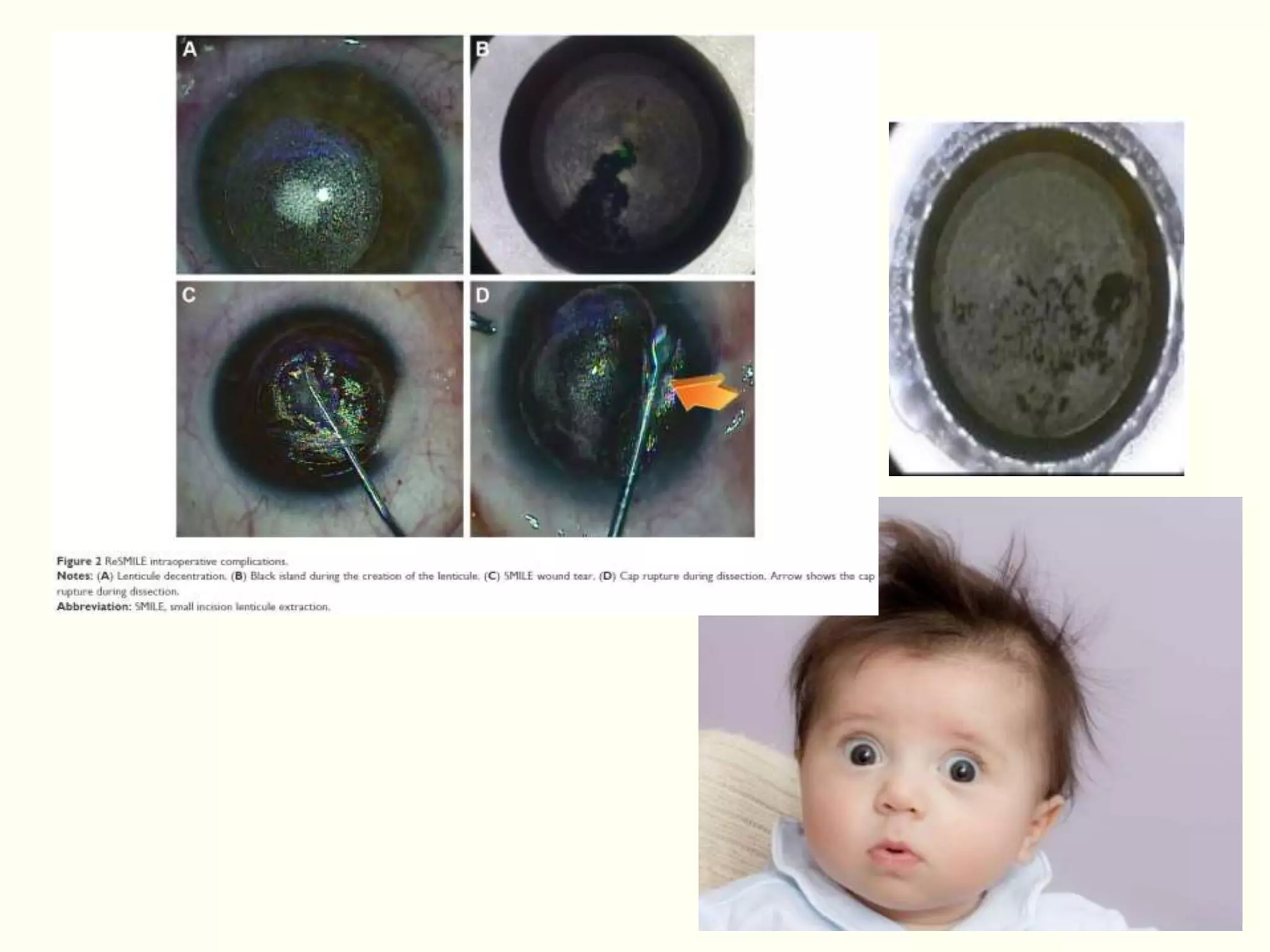 Just SMILE (small incision lenticule extraction ) | PPTX
