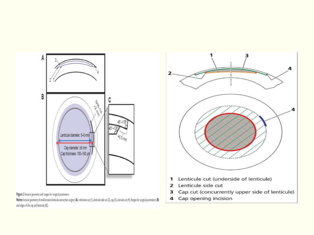 Just SMILE (small incision lenticule extraction ) | PPTX | Eye and ...