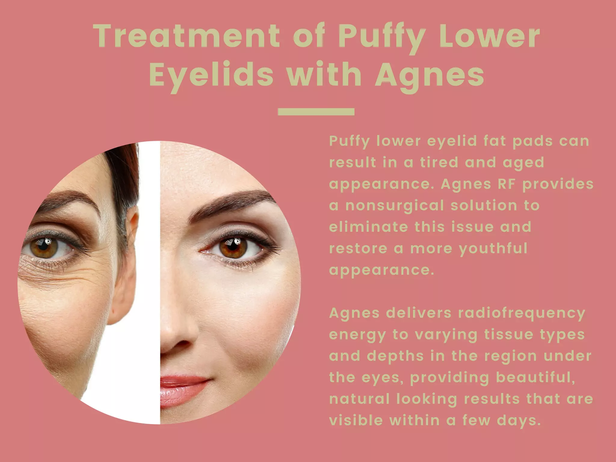 Your Guide to Agnes RF Microneedling Treatments | PDF