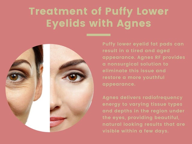 Your Guide to Agnes RF Microneedling Treatments | PPT