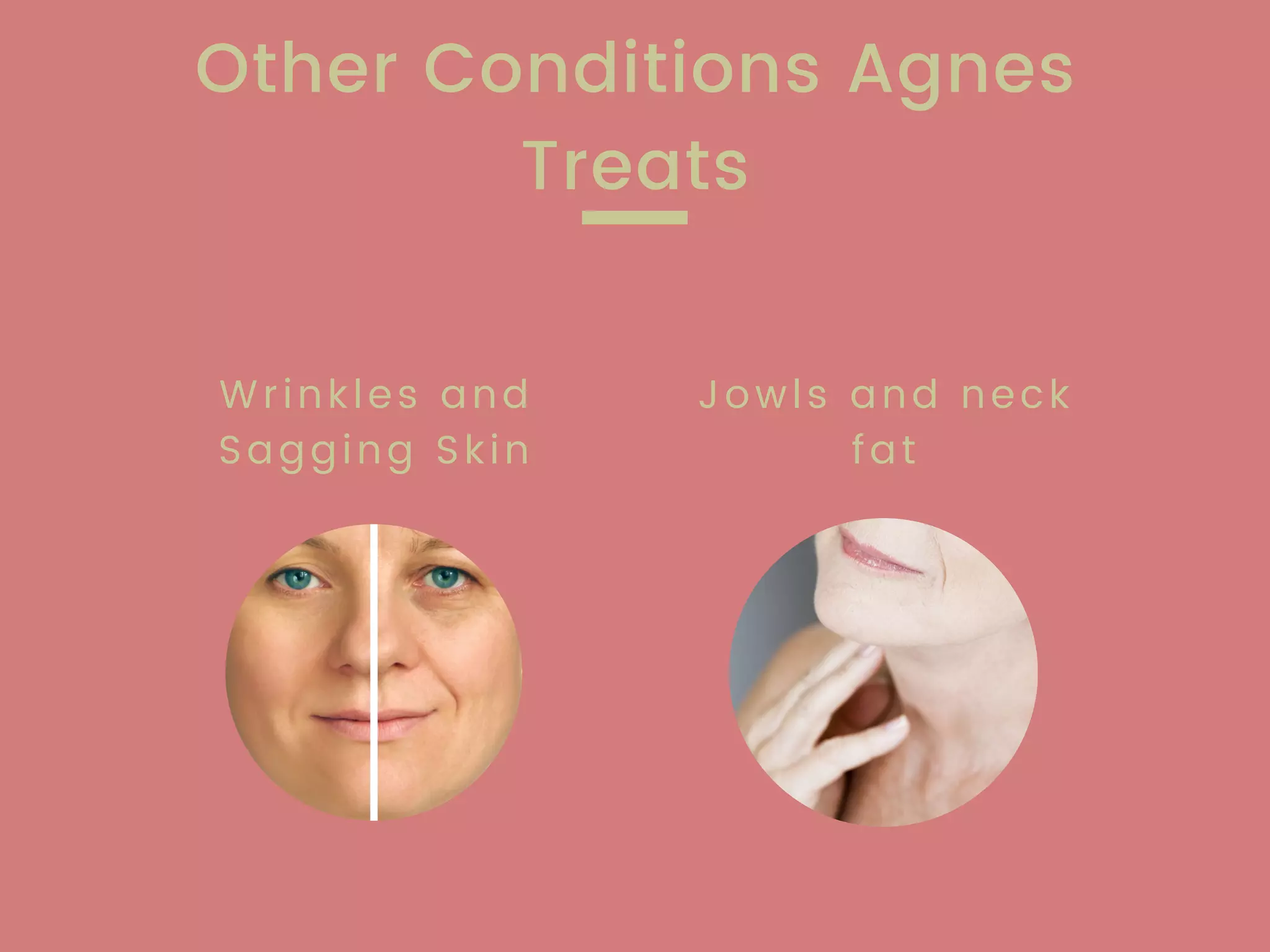 Your Guide to Agnes RF Microneedling Treatments | PDF