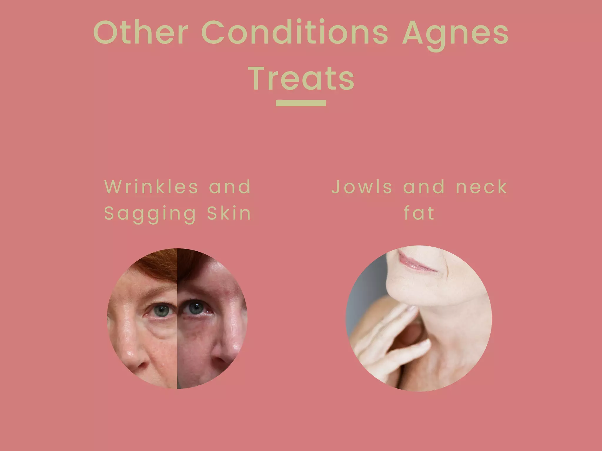 Your Guide to Agnes RF Microneedling Treatments | PDF