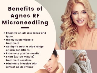 Your Guide to Agnes RF Microneedling Treatments | PDF