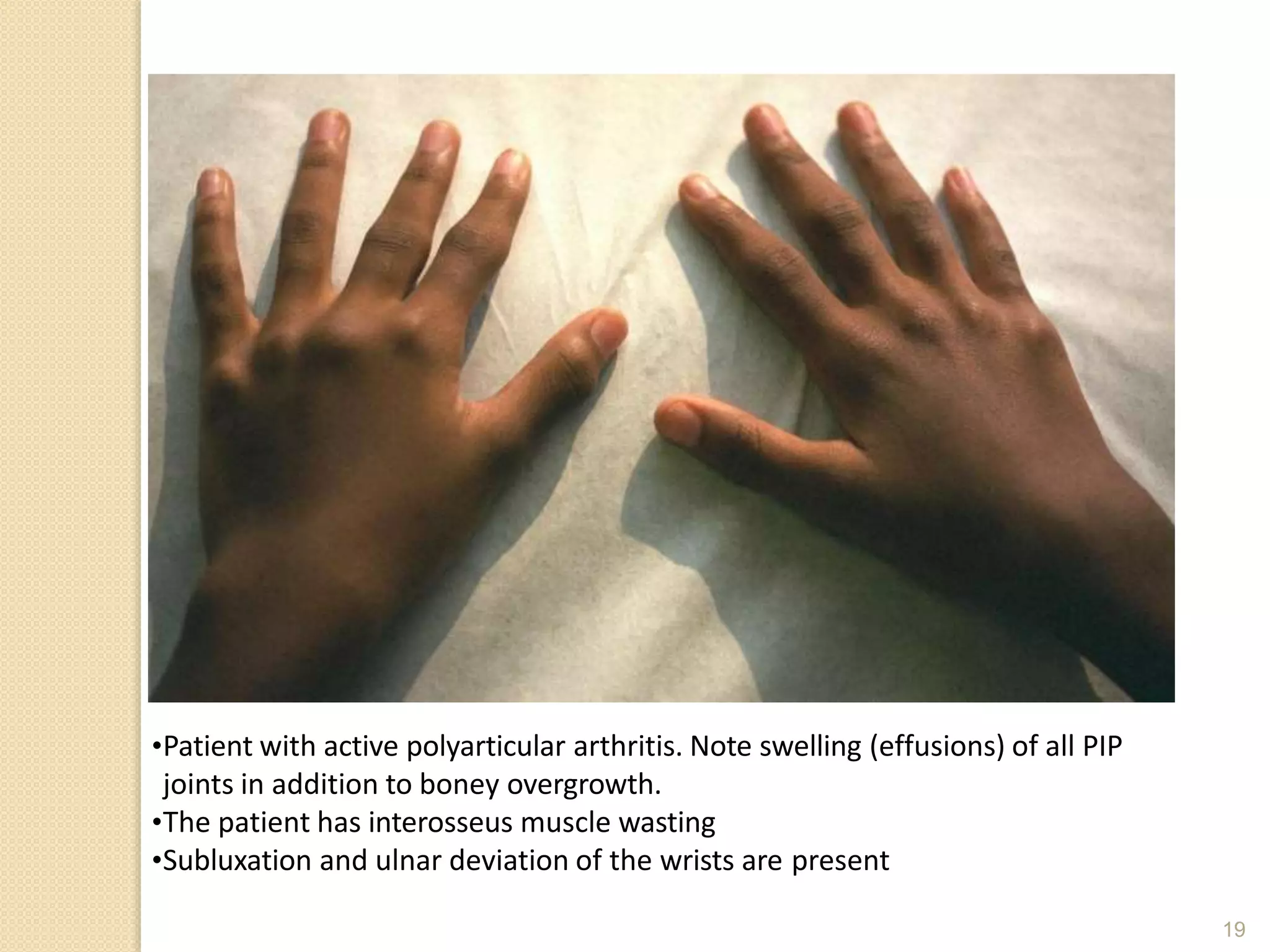 Juvenile arthritis an overview | PPTX