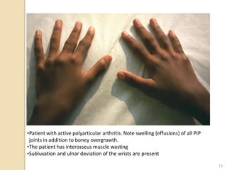 Juvenile arthritis an overview | PPT