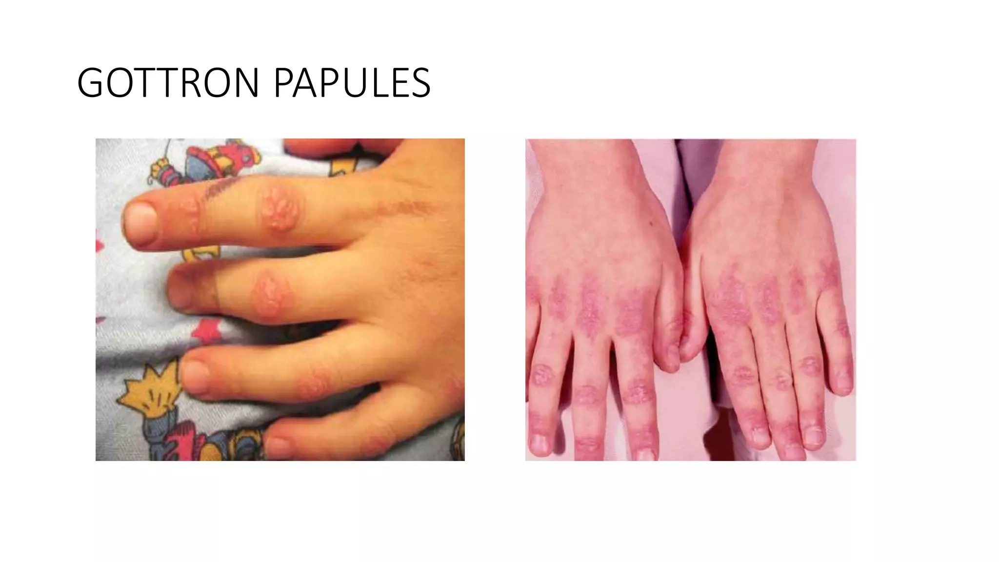Juvenile dermatomyositis.pptx