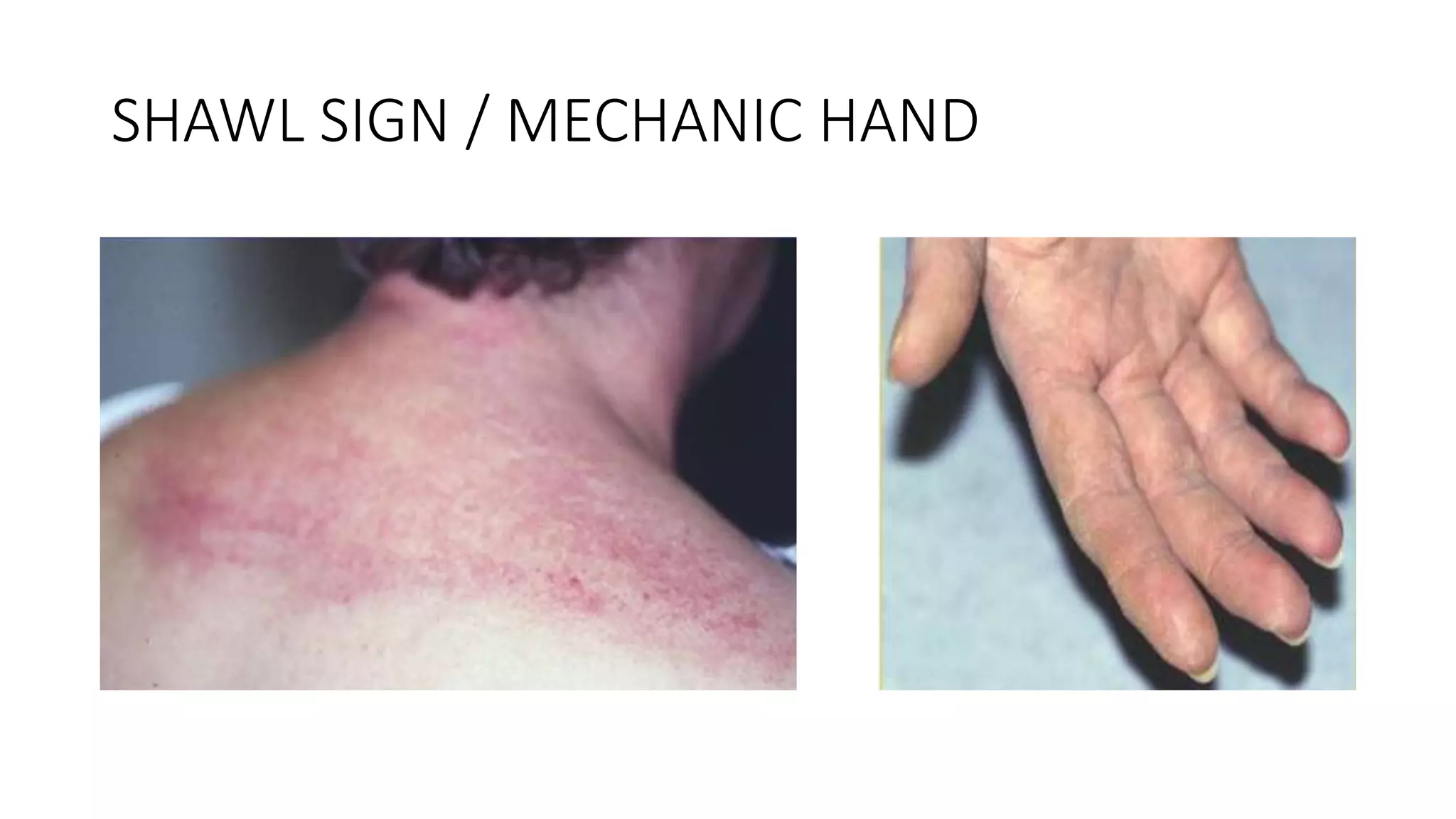 Juvenile dermatomyositis.pptx