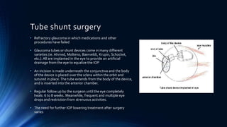 Juvenile glaucoma: a case study and disease review | PPTX